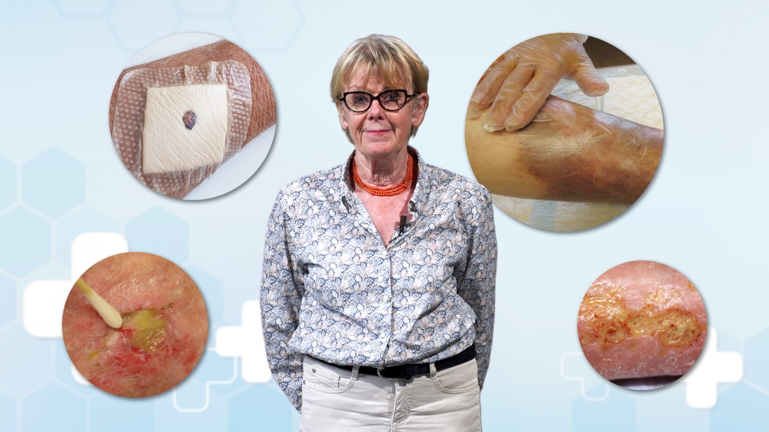 Sårbehandling för undersköterskor och omsorgspersonal